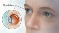 Blurry Vision after Cataract Surgery - what is Normal and what is Not ...