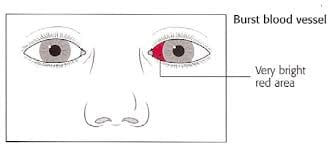 What does a Burst Blood Vessel in Your Eye Mean? - Maple Grove Eye ...
